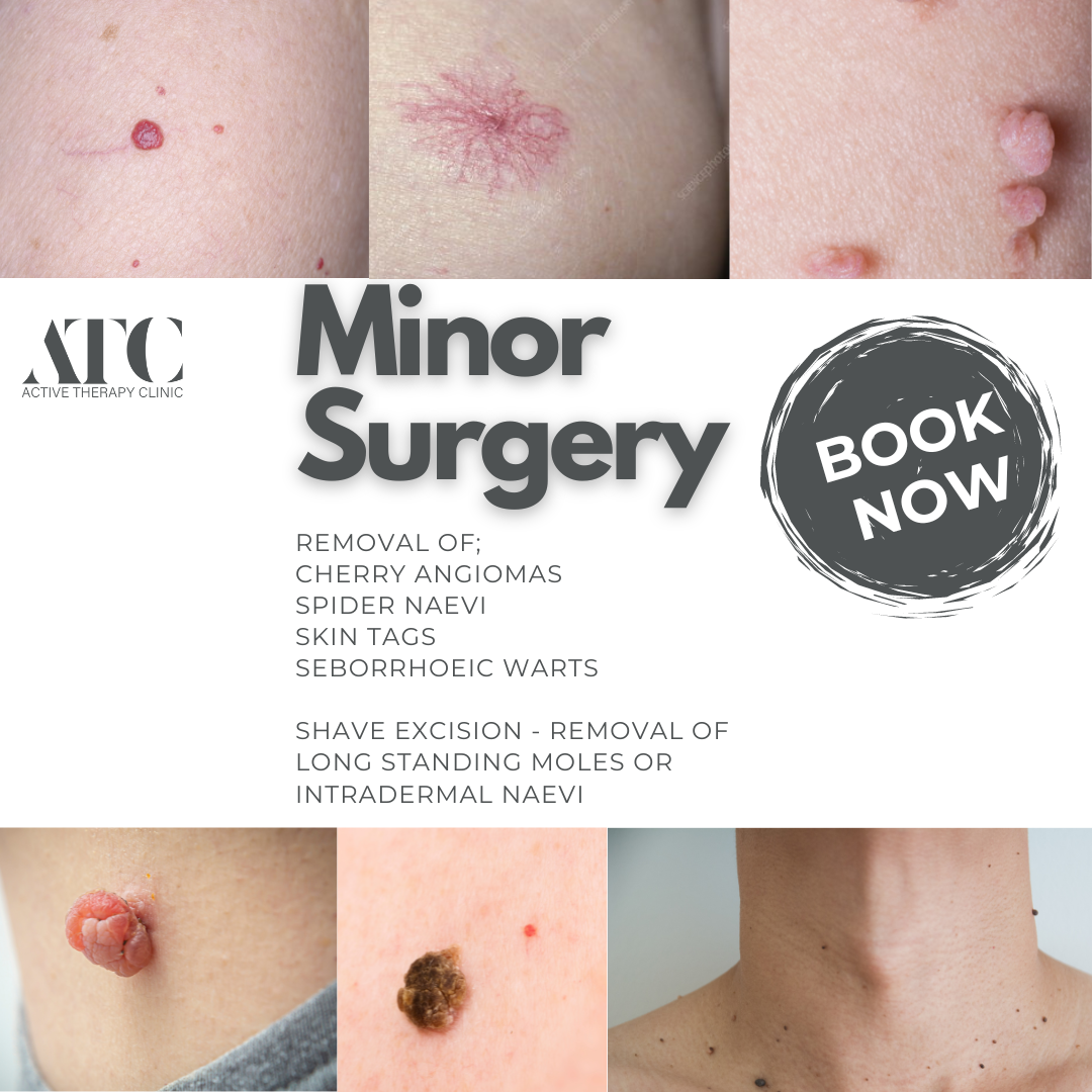 Minor Surgery Now Available - Active Therapy Clinic
